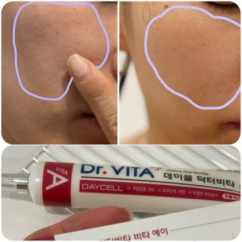 약국 비타민a크림 효능 스티바a크림 대체 내돈내산 후기 네이버 블로그
