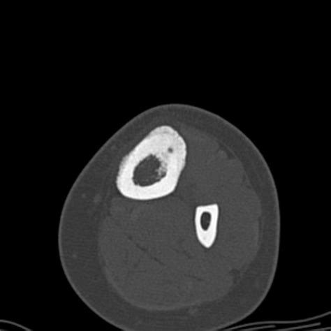 Osteoid Osteoma Pacs
