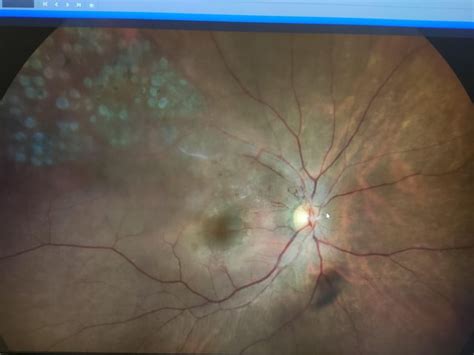 Sectoral Photocoagulation After Brvo Neovascularisation Or Collaterals