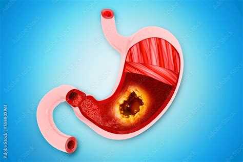 Stomach Cancer Gastric Cancer Symptoms Stages Treatment 3d