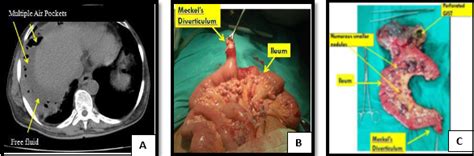 A Preoperative Ct Scan Showing Gist With Sign Of Perforation Download Scientific Diagram