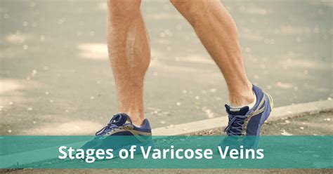 Varicose Veins Various Stages With Pictures Medfin