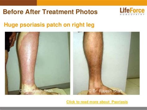 Psoriasis On Legs Photos Before After Treatment Pictures Of Patients