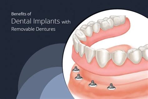 Why Should You Choose Dental Implants With Removable Dentures Dental