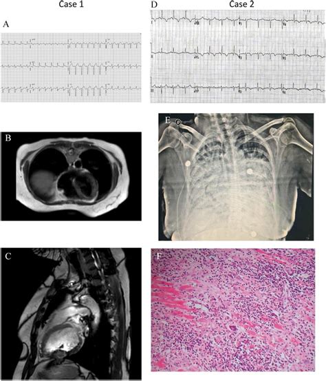 a 54 year old female electrocardiogram with diffuse st segment