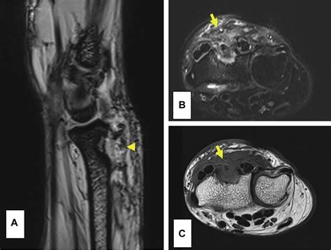 Parosteal Osteosarcoma Of The Distal Radius Mimicking An Osteochondroma