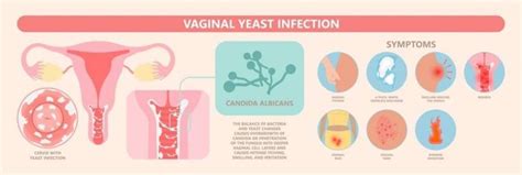 How Long To Wait For Sex After Yeast Infection
