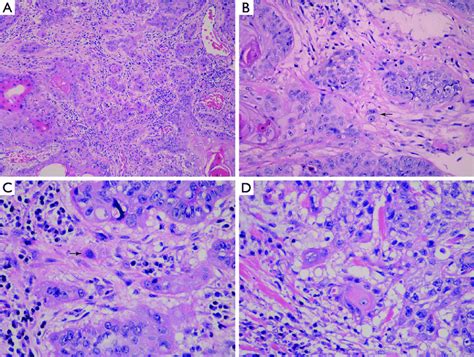 Histologic Features Of Tumor Stroma Ratio Tsr Tumor Budding Single
