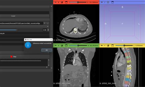 Automatic Spine Segmentation In Slicer Pycad Your Medical Imaging