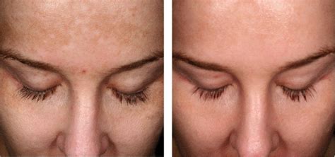 Laser Skin Lightening Whitening Treatment In Mumbai