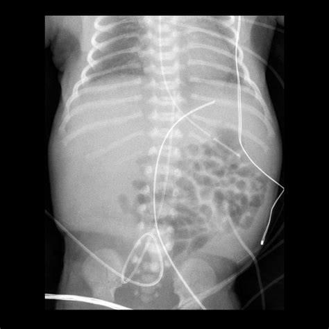 Premature Newborn Status Umbilical Venous Catheter Placement Pediatric Radiology Case