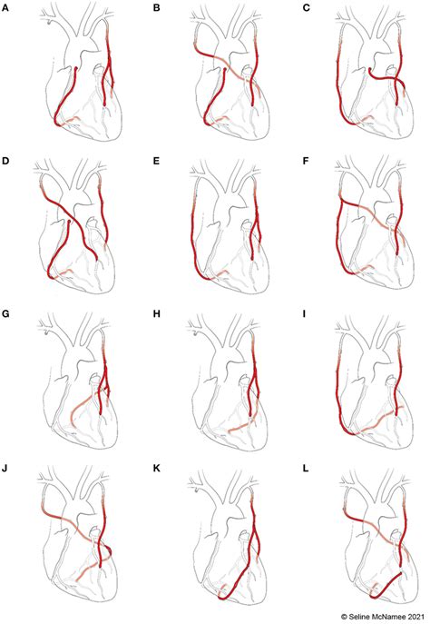 Figure E Total Arterial Grafting Configurations A Configuration A