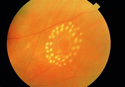 Ophthalmoscope View Of Laser Treated Retinal Hole Photograph By Sue