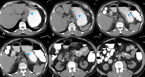 Plain Ct Showing Extensive Diffuse Mucosal Fold Thickening Download Scientific Diagram