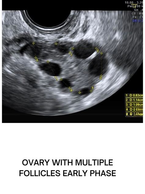 Ovarian Follicle Ultrasound Investigation Of Ovarian Follicular Waves