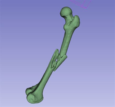 Femur Fracture Reconstruction Extremity Lower Leg