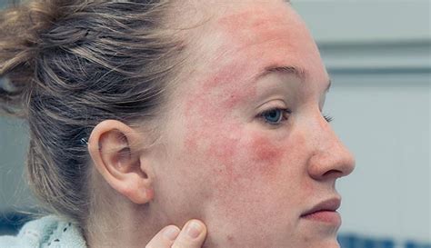 Stress Rash On Face