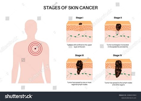 Melanoma Skin Cancer Stages Melanoma Skin Cancer Stages