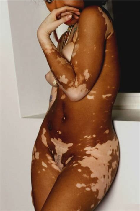 Ebony Babe With Vitiligo Starway