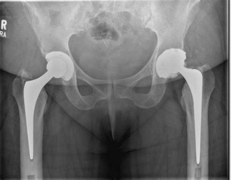 Ap Radiograph Pelvis Download Scientific Diagram