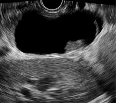Mucinous Cystic Neoplasm With Solid Component Download Scientific Diagram