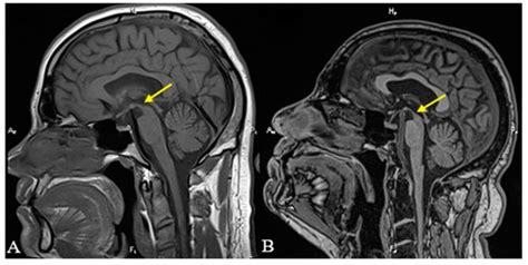 Imaging Criteria For The Diagnosis Of Progressive Supranuclear Palsy