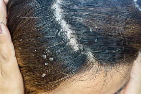 Seborrheic Dermatitis Scalp African American Hair