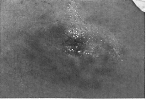 Lupus Erythematosus Associated Primary And Secondary Anetoderma