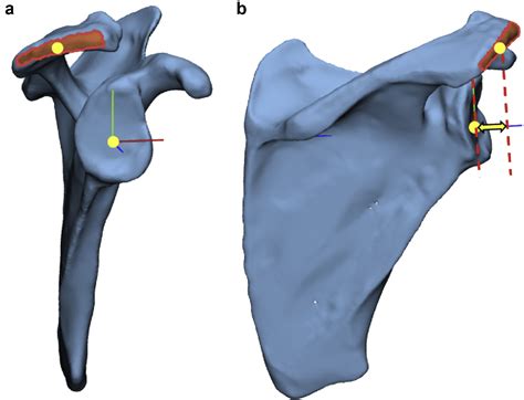 Figure 2 From Acromial And Glenoid Morphology In Glenohumeral