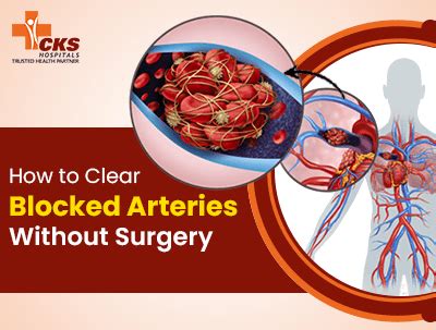 How To Clear Blocked Arteries Without Surgery Ultimate Guide