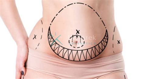 Flank Liposuction Overview Sculpt Your Waist 2025