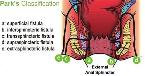 Perianal Crohns Definitions Fistula Chronic Tract Of Granulation