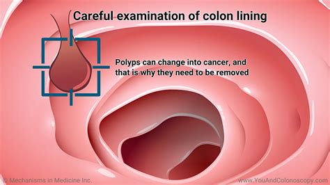 Slide Show What Happens During And After A Colonoscopy