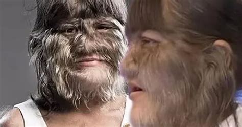 Dünyanın En Tüylü Kızıydı Kurt Kız Olarak Tanınıyordu Aşık Olunca Kolları Sıvadı Son Halini