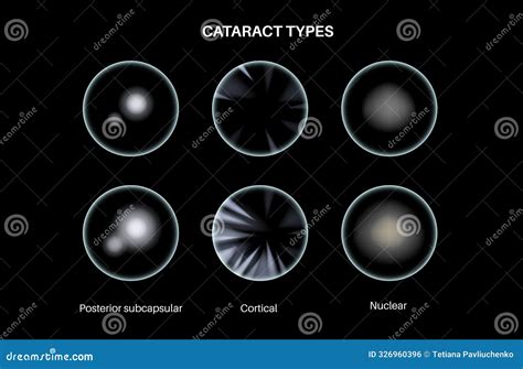 Cataract Eye Disease Vector Illustration 326960396