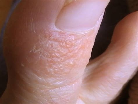 Tổ Đỉa Chàm Dạng Trứng Sam Nguyên Nhân Và Cách Trị