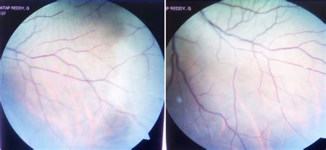 Ab Fundoscopy Showing Retinal Opacification And Box Carring