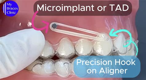 Elastics For Invisalign Mybracesclinic