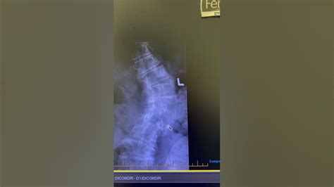 Scoliosis حالة اعوجاج بالعمود الفقري Youtube
