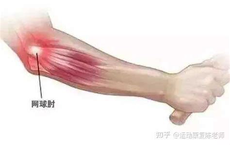 什么是网球肘，得了网球肘应该怎么办？ 知乎