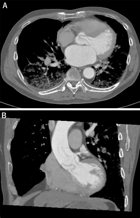 Figure 2 From Subendocardial Ischemia Caused By Acute Severe Aortic Regurgitation Due To Aortic