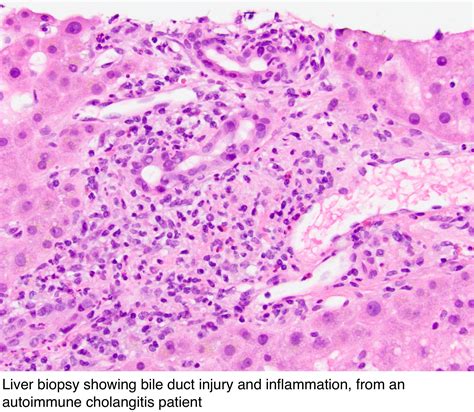 Pathology Outlines Autoimmune Cholangitis