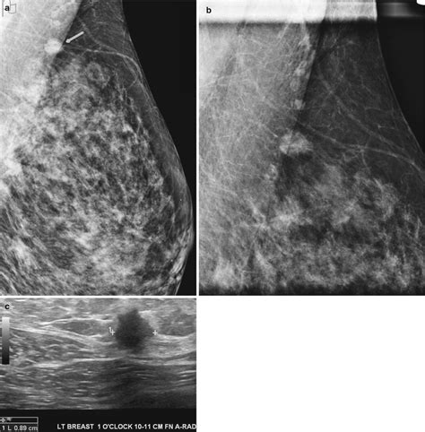Mammographic Signs Of Breast Cancer Oncohema Key