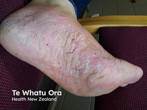 Acquired Palmoplantar Keratoderma Images