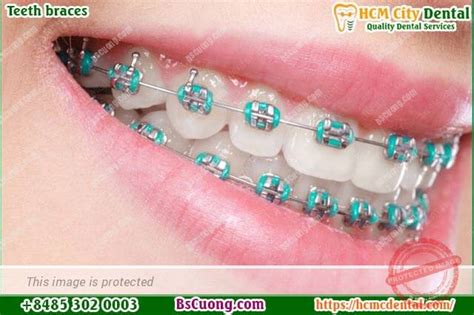 Teeth Braces Everything You Need To Know About Teeth Braces