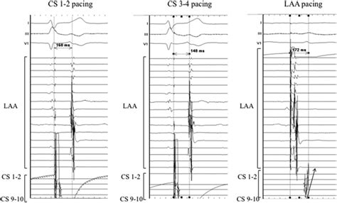Bidirectional Block Of The Mitral Isthmus Was Confirmed By The Download Scientific Diagram