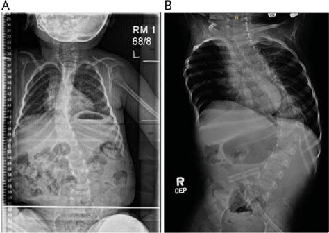 Scoliosis In 2 Patients With Spinal Muscular Atrophy Download