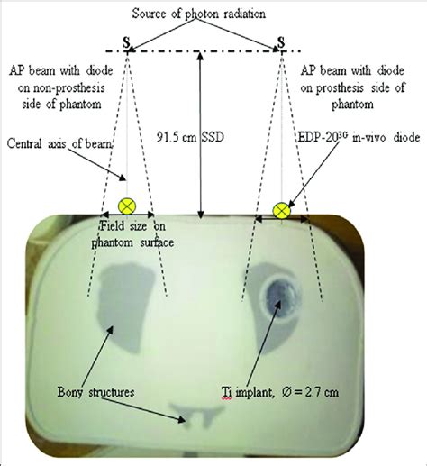 Single Ap Beam Setups In The Phantom Slice For 6 Mv And 10 Mv Photon Download Scientific