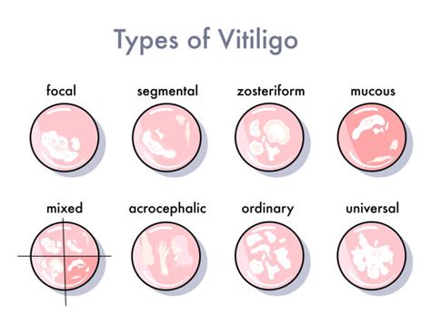 340 Vitiligo Pattern Stock Illustrations Royalty Free Vector Graphics