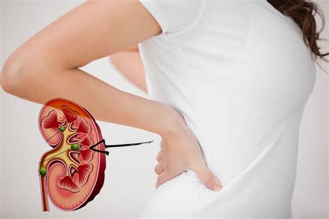 ¿qué Son Las Enfermedades Renales Reino Ganoderma
